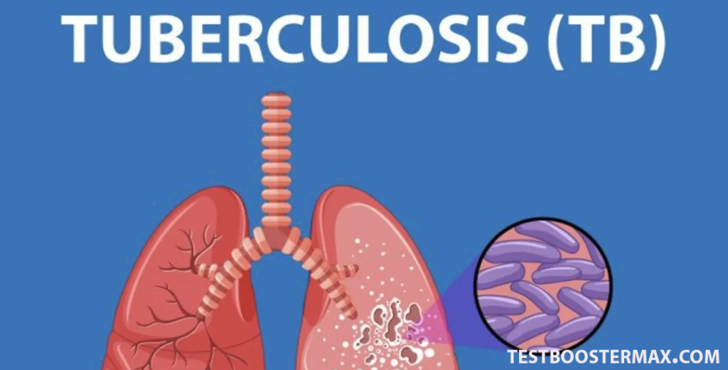 Penyakit Tuberkulosis (TBC): Kenali Gejala batuk nya – TestBoosterMax